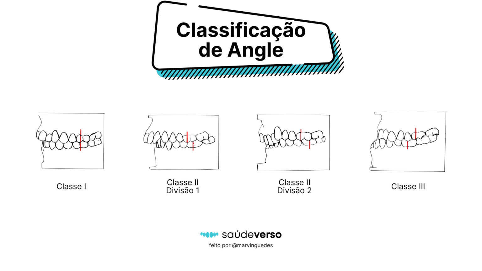 Classificação de Angle - Entenda as Classes e Divisões